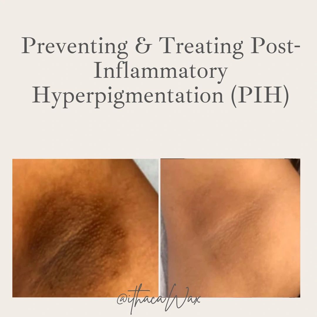 Preventing & Treating Post-Inflammatory Hyperpigmentation (PIH)